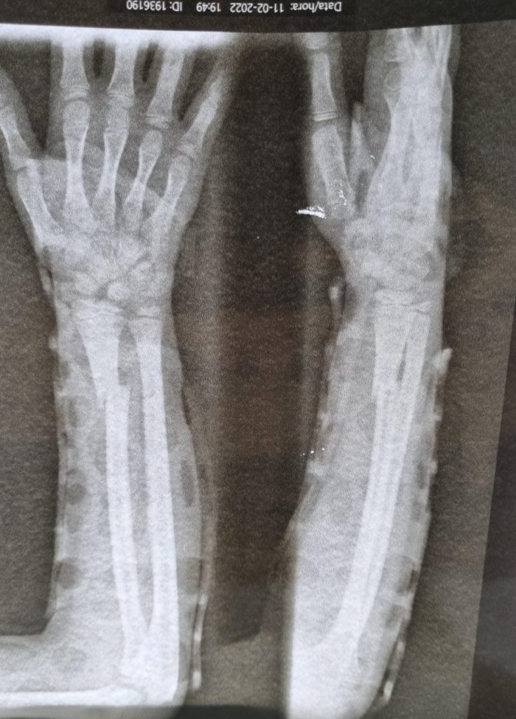 Relato de caso: redução de fratura do terço distal do rádio feita com ...