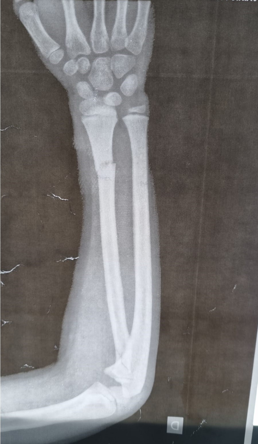 Relato de caso: redução de fratura do terço distal do rádio feita com ...